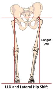 Leg Length Discrepancy: Is it Causing Your Pain and Dysfunction? | NETA