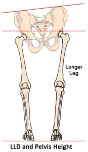 Leg Length Discrepancy: Is it Causing Your Pain and Dysfunction? | NETA
