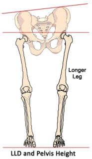 Leg Length Discrepancy: Is it Causing Your Pain and Dysfunction? | NETA